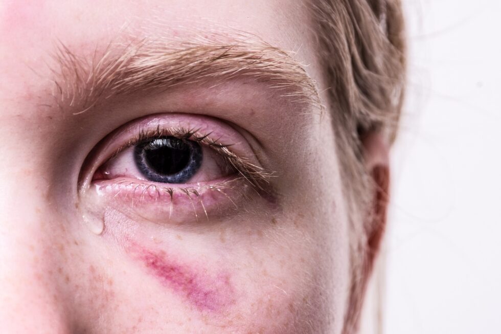 Atopijski dermatitis in najbolj pogoste pridružene bolezni - Društvo ...